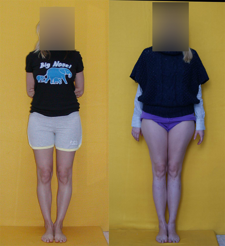 Height Increase Operation limb Lengthening Height Increase Operation limb Lengthening