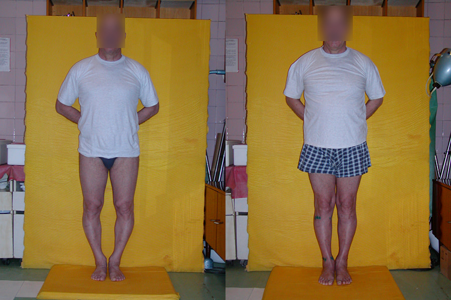 Operative Correction Of Bowed Legs Or Knock Knees Photos Of Patients